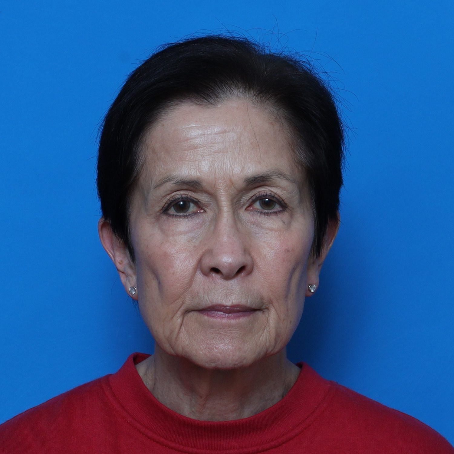 Alabama Brow Lift Patient Photo Case 10836